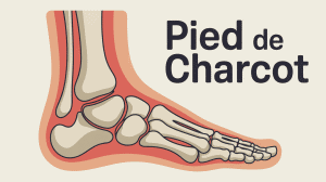 Pied De Charcot : Signes, Prise En Charge Et Prévention Chez Les ...